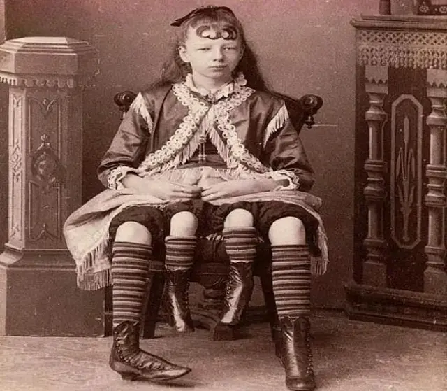 The girl was born with 4 legs, became famous at 13, married at 19, gave ...